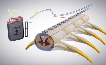 Australia's Saluda Medical raises $125m | AVCJ